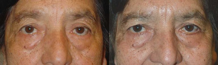 Eyelid Ectropion Surgery Treatment Specialists | Beverly Hills