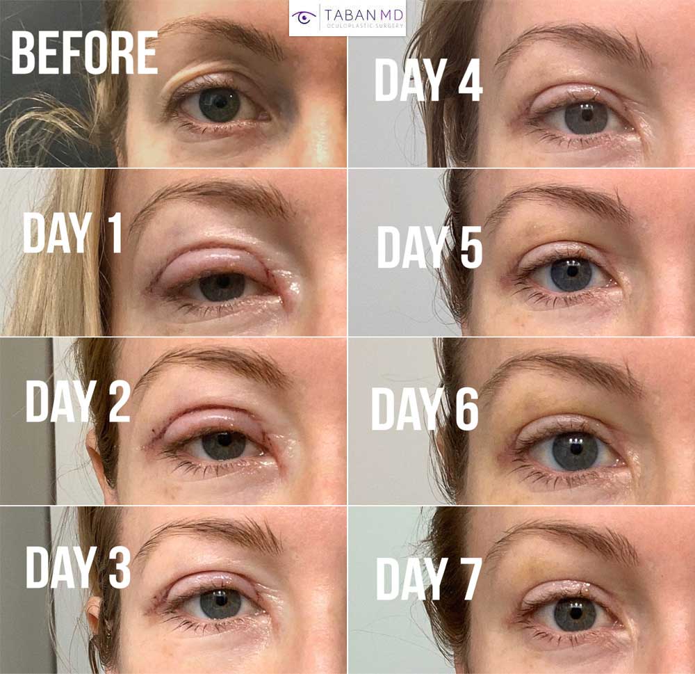 Eyelid Reduction Surgery New Arrivals Eyelid Reduction Surgery New Arrivals