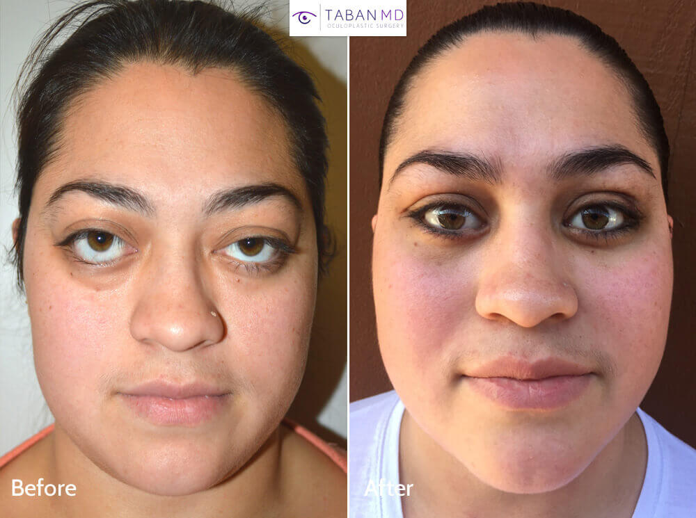 Graves Disease