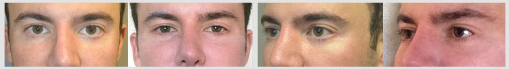 What is Canthoplasty Surgery | Lateral Canthoplasty