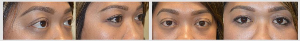 Orbital Decompression Surgery Beverly Hills - Bulgy Eye Surgery | Taban