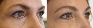 Cosmetic Filler Injection - Eyelid Filler Expert Beverly Hills