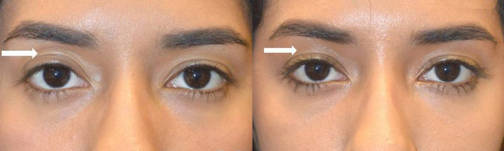Eye Asymmetry Surgery and Treatment | Fix Uneven Eyes