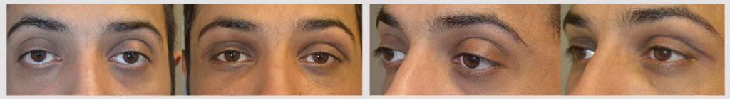 Customized Infraorbital Rim Implant Beverly Hills | Tear Trough Implant