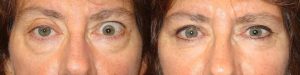 Eye Asymmetry Surgery and Treatment | Fix Uneven Eyes