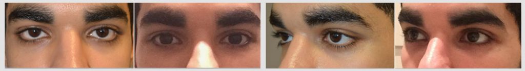 Customized Infraorbital Rim Implant Beverly Hills | Tear Trough Implant