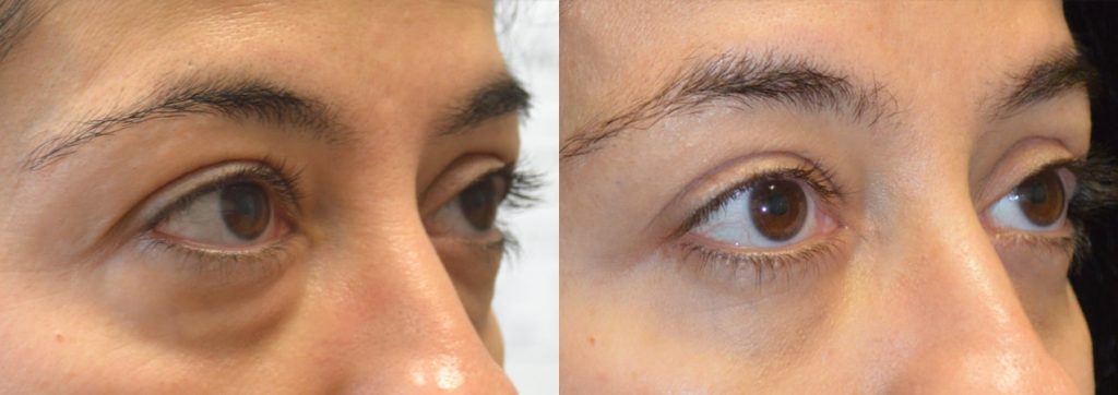 Tear Trough Treatment | Sunken Eye Treatment | Hollow Eyes Treatment