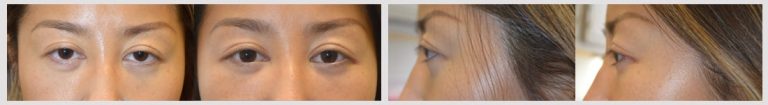 Customized Infraorbital Rim Implant Beverly Hills | Tear Trough Implant