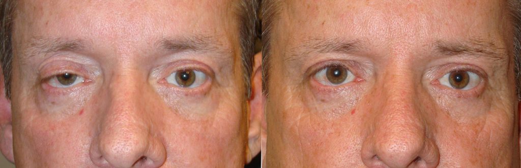 Eye Asymmetry Surgery and Treatment | Fix Uneven Eyes