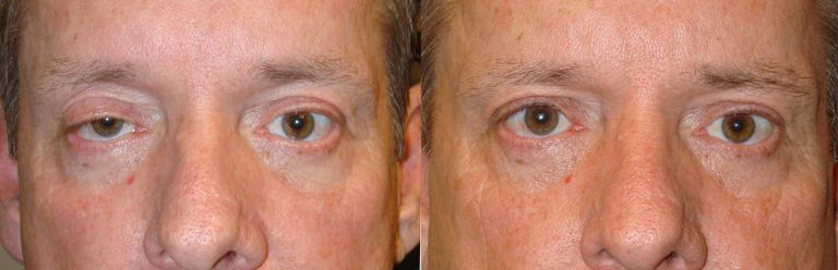 Eye Asymmetry Surgery and Treatment | Fix Uneven Eyes