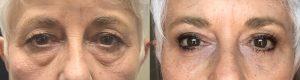 What is Eye Shape Change? Dr. Taban MD | Beverly Hills, Ca