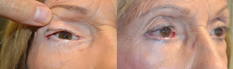 Eyelid Revision Surgery Beverly Hills | Revision Blepharoplasty