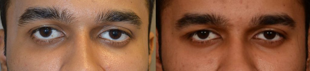 Eye Asymmetry Surgery and Treatment | Fix Uneven Eyes