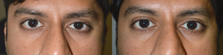 Eye Asymmetry Surgery and Treatment | Fix Uneven Eyes