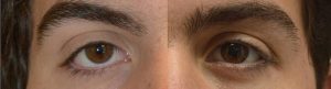 What is Canthoplasty Surgery | Lateral Canthoplasty