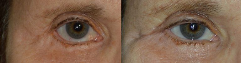 Beverly Hills Eyelid Retraction | Graves Disease Treatment