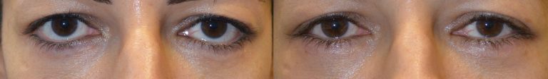 Beverly Hills Eyelid Retraction | Graves Disease Treatment