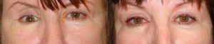 Eye Asymmetry Surgery and Treatment | Fix Uneven Eyes