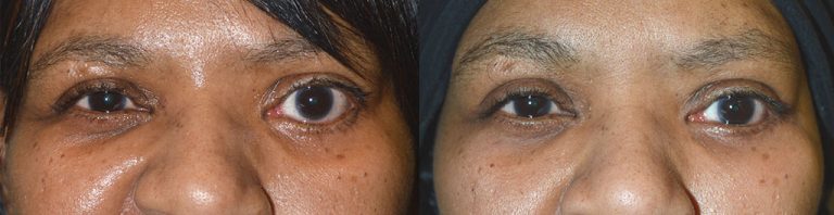 Eye Asymmetry Surgery and Treatment | Fix Uneven Eyes