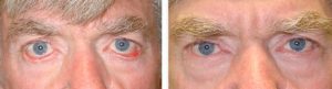Eyelid Ectropion Surgery Treatment Specialists | Beverly Hills