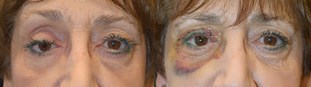 Prosthetic Eye Socket Surgery Specialists in Beverly Hills