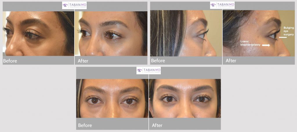 Thyroid Eye Beverly Hills | Graves Disease