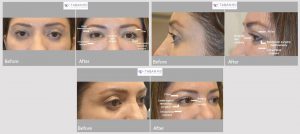 Customized Infraorbital Rim Implant Beverly Hills | Tear Trough Implant