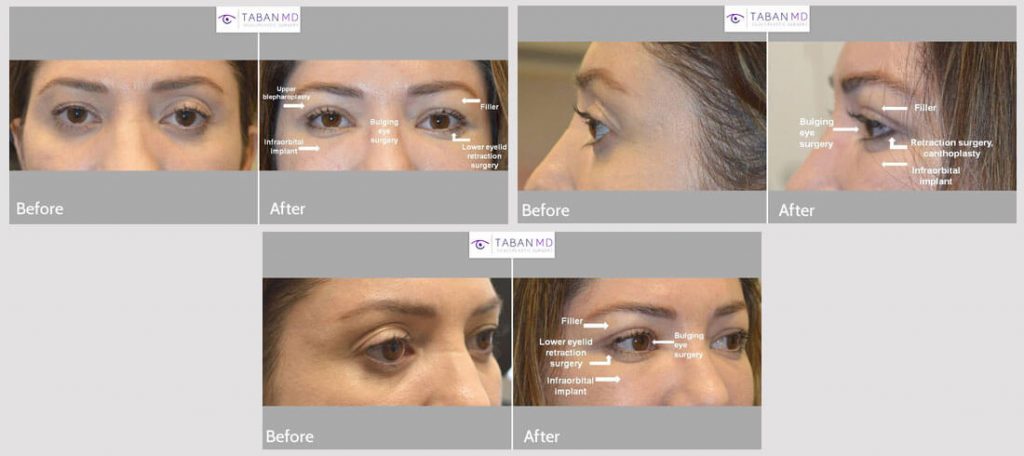 Tear Trough Treatment | Sunken Eye Treatment | Hollow Eyes Treatment
