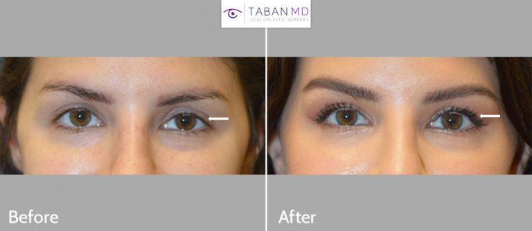 Eye Asymmetry Surgery and Treatment | Fix Uneven Eyes