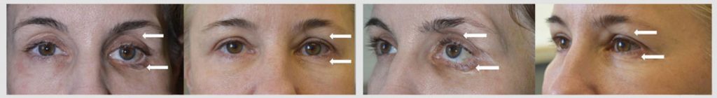 Eye Trauma Fracture Orbital Blow Out Treatment Beverly Hills