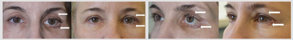 Beverly Hills Eyelid Retraction | Graves Disease Treatment