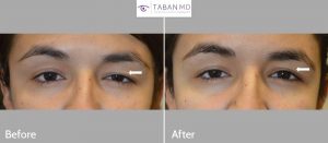 Eye Asymmetry Surgery and Treatment | Fix Uneven Eyes