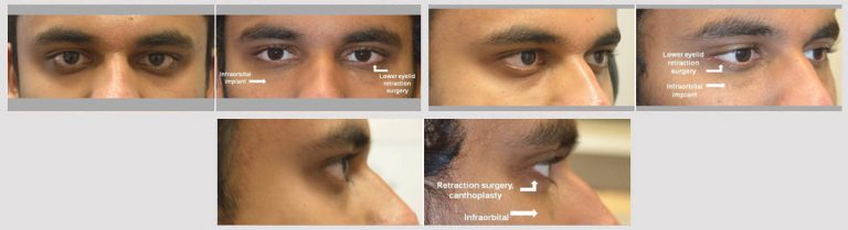 Customized Infraorbital Rim Implant Beverly Hills | Tear Trough Implant