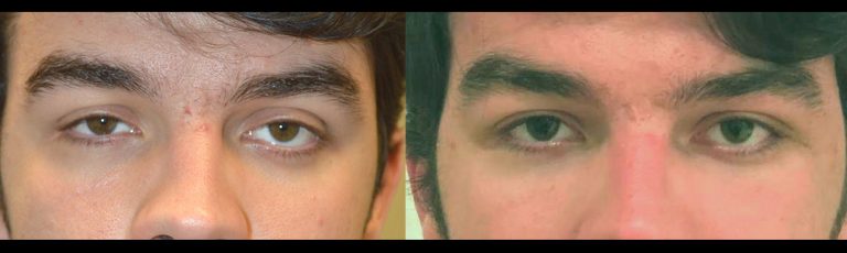 Eye Asymmetry Surgery and Treatment | Fix Uneven Eyes