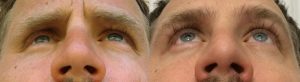 Eye Trauma Fracture Orbital Blow Out Treatment Beverly Hills
