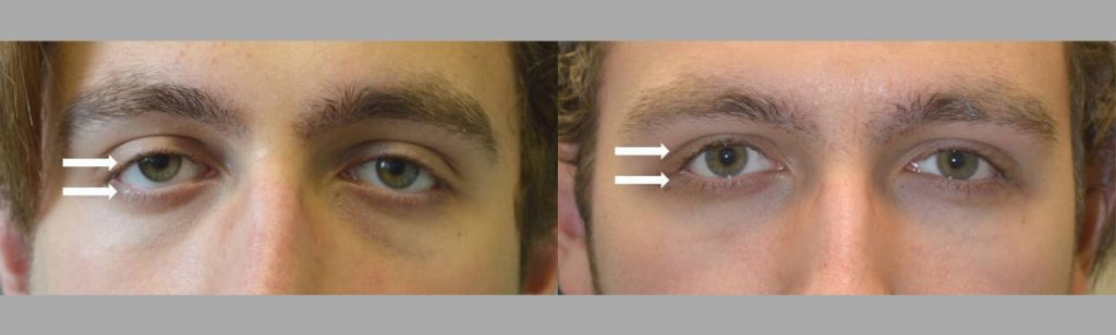 Almond Eye Surgery in Beverly Hills | Dr. Taban Almond Eye Specialist