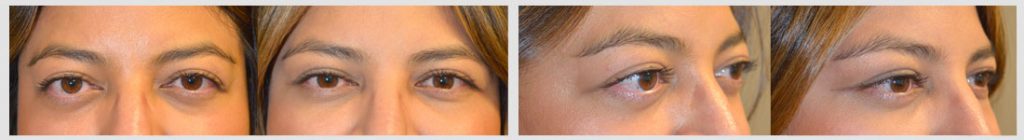 Orbital Decompression Surgery Beverly Hills - Bulgy Eye Surgery | Taban