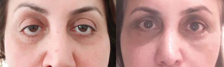 What is Eye Shape Change? Dr. Taban MD | Beverly Hills, Ca