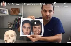 Eye Asymmetry Surgery and Treatment | Fix Uneven Eyes