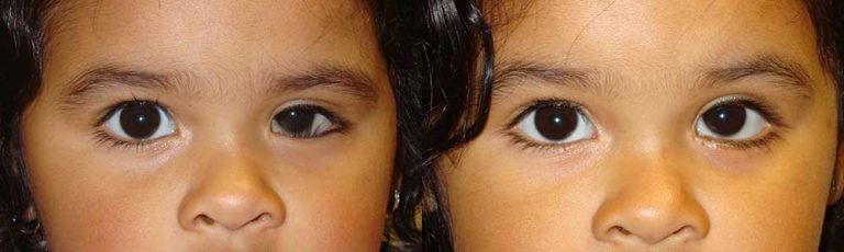 Eyelid Ectropion Surgery Treatment Specialists | Beverly Hills