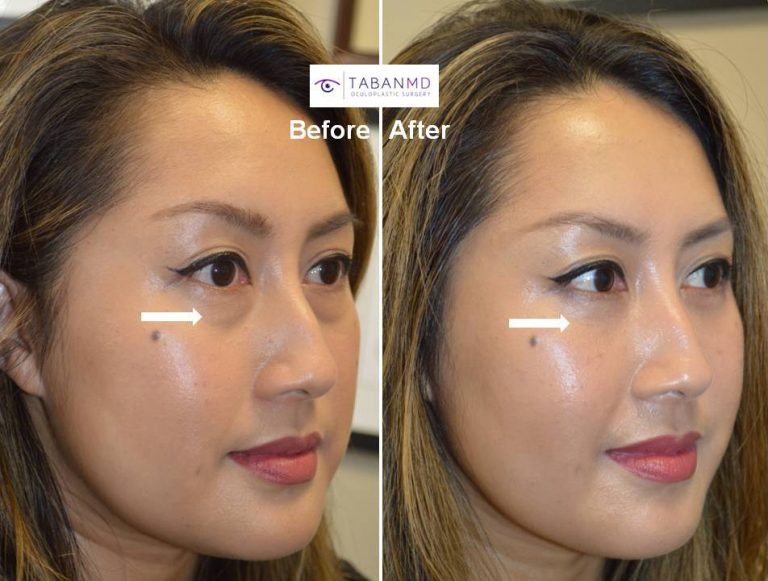 Lower Blepharoplasty Beverly Hills | Under Eye Bag | Dark Circle