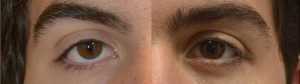 Ptosis Surgery Beverly Hills | Droopy Eyelid Surgery Los Angeles