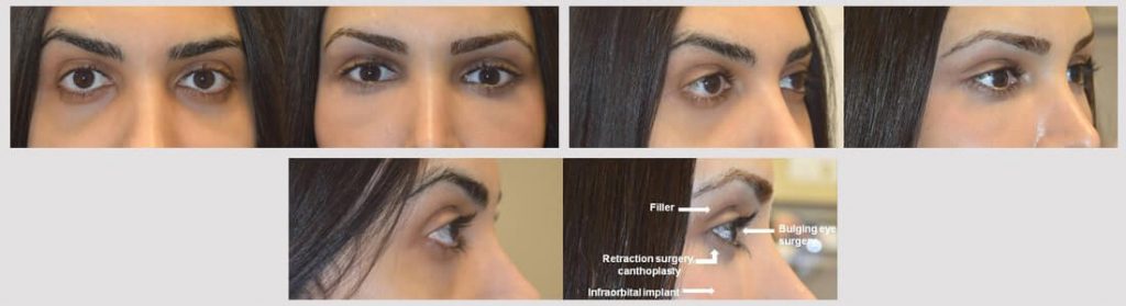 Orbital Decompression Surgery Beverly Hills - Bulgy Eye Surgery | Taban