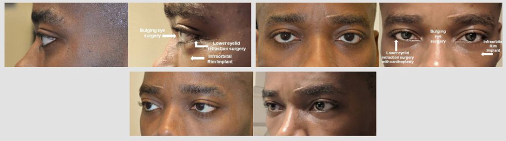 What is Eye Shape Change? Dr. Taban MD | Beverly Hills, Ca