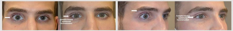 Eye Trauma Fracture Orbital Blow Out Treatment Beverly Hills