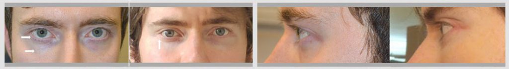 Customized Infraorbital Rim Implant Beverly Hills | Tear Trough Implant