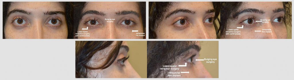 Orbital Decompression Surgery Beverly Hills - Bulgy Eye Surgery | Taban