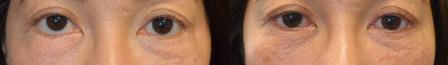 Beverly Hills Eyelid Retraction | Graves Disease Treatment