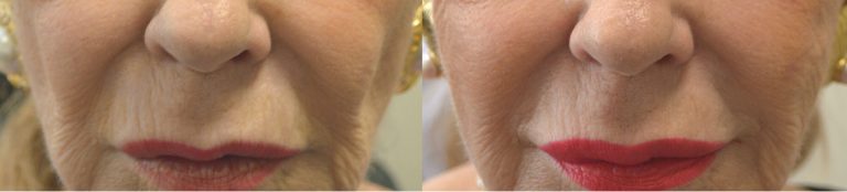 Cosmetic Filler Injection - Eyelid Filler Expert Beverly Hills