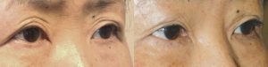 Eyelid Revision Surgery Beverly Hills | Revision Blepharoplasty